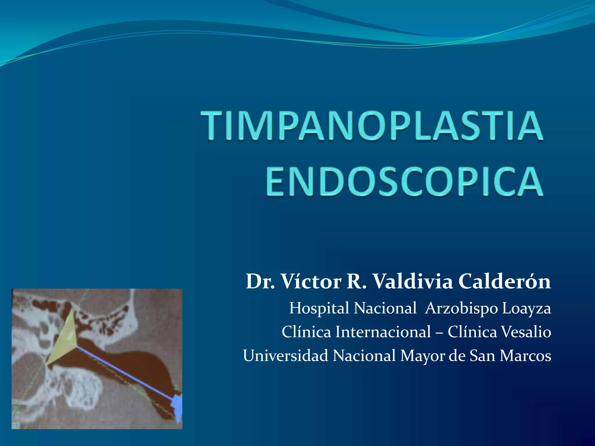 Timpanoplastia endoscopica | PPTX
