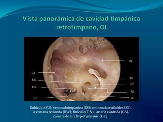 Timpanoplastia endoscopica | PPT