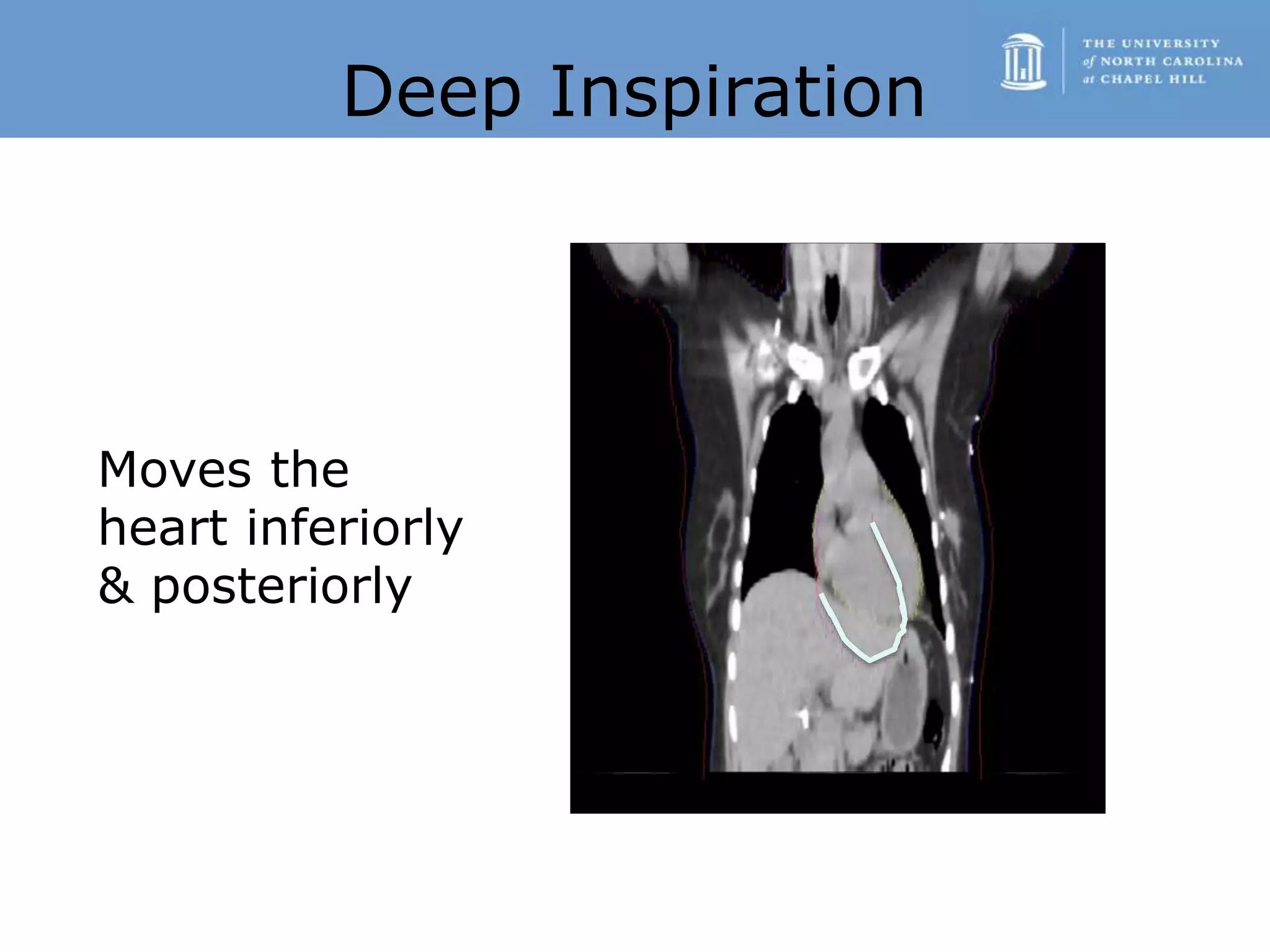 Prospective Assessment of Deep Inspiration Breath Hold to Prevent ...