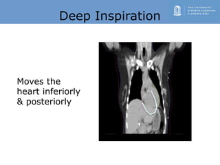 Prospective Assessment of Deep Inspiration Breath Hold to Prevent ...