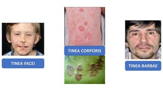 TINEA.pptx