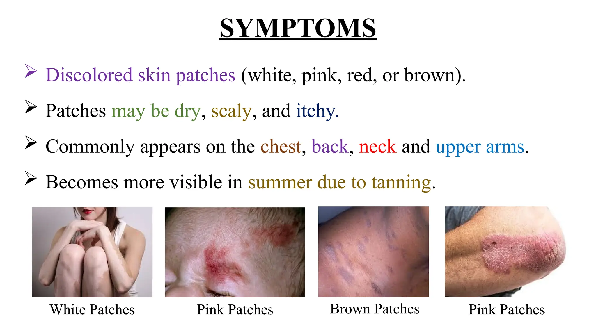 Tinea Versicolor !! Superficial Mycoses !! Fungus !! Clinical ...