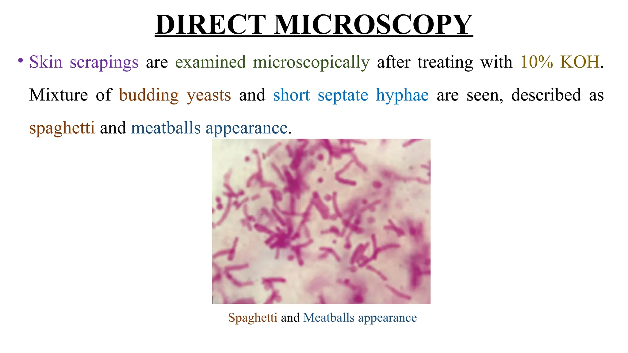 Tinea Versicolor !! Superficial Mycoses !! Fungus !! Clinical ...