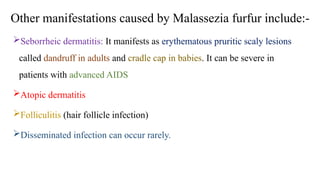 Tinea Versicolor !! Superficial Mycoses !! Fungus !! Clinical ...