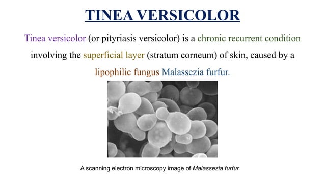 Tinea Versicolor !! Superficial Mycoses !! Fungus !! Clinical ...