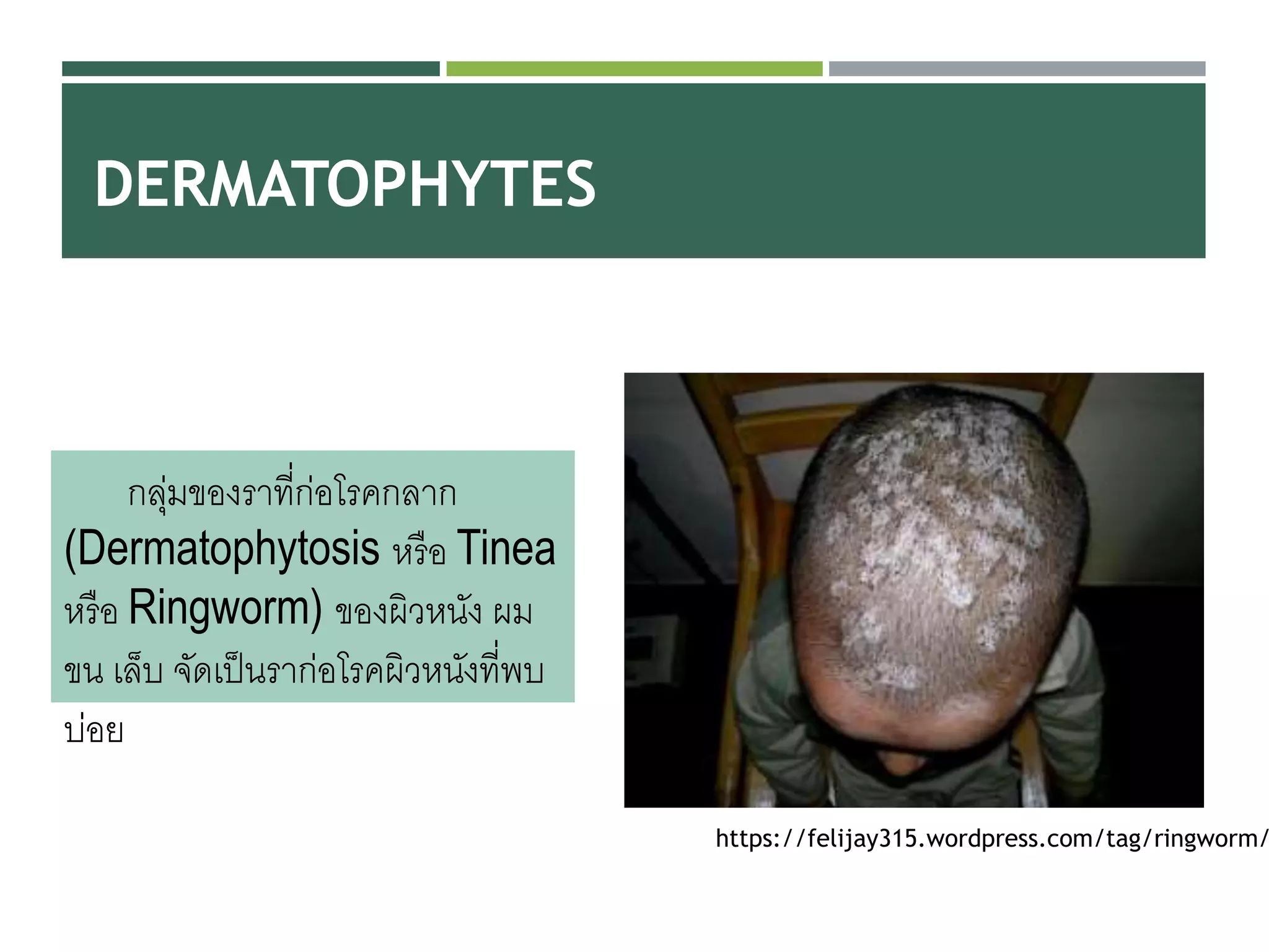 Tinea capitis | PPTX