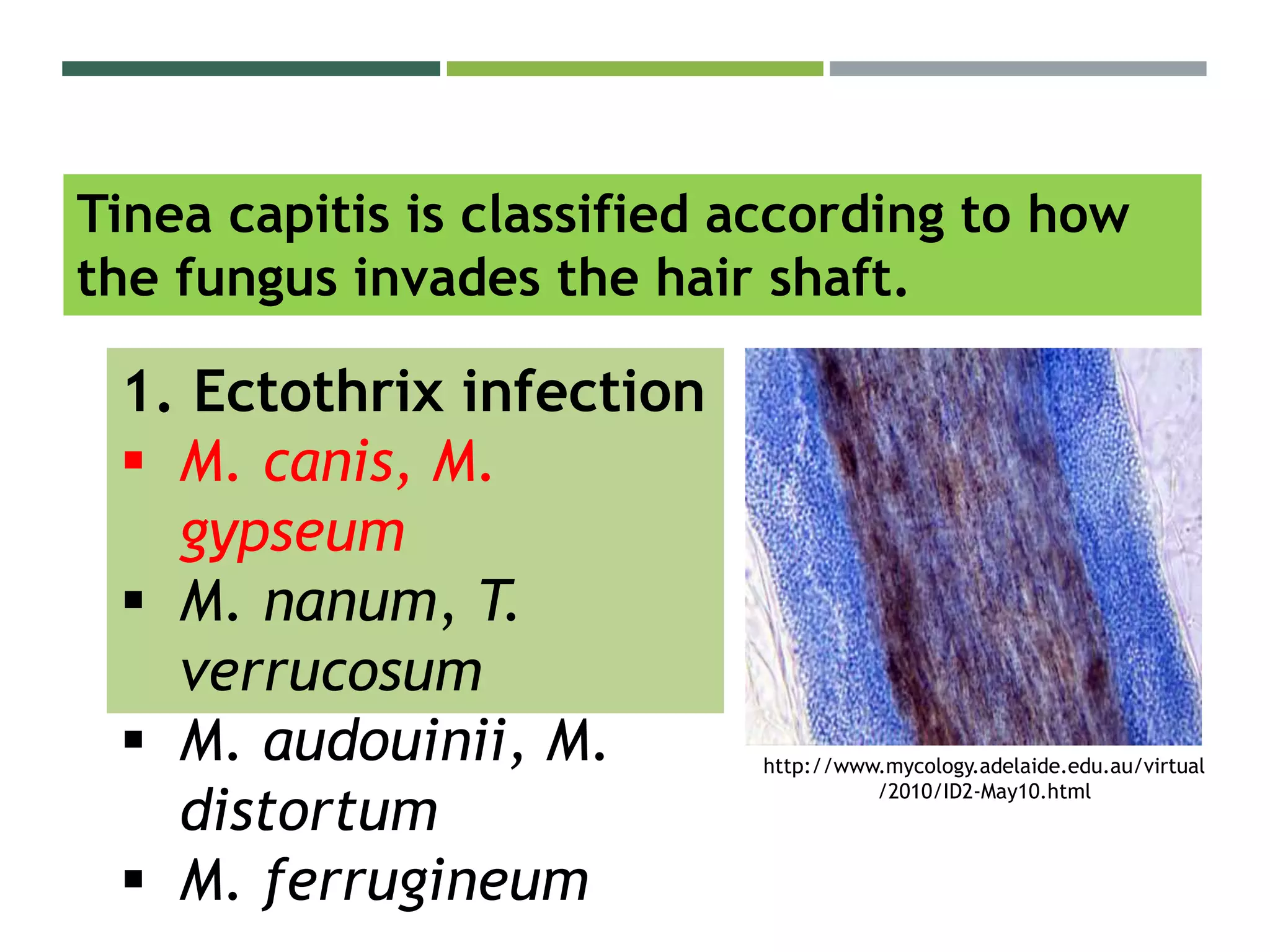 Tinea capitis | PPTX