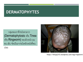 Tinea capitis | PPTX