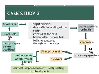 Tinea capitis | PPTX