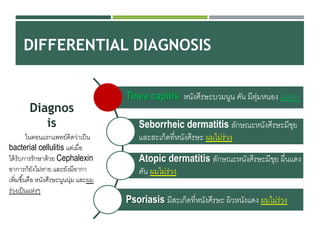 Tinea capitis | PPTX