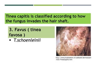 Tinea capitis | PPT