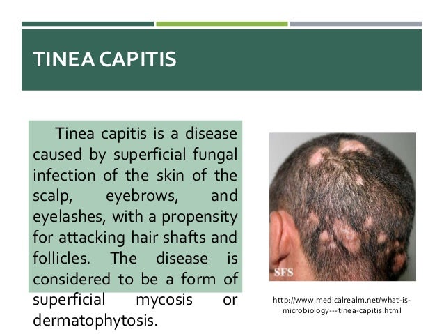 Tinea capitis