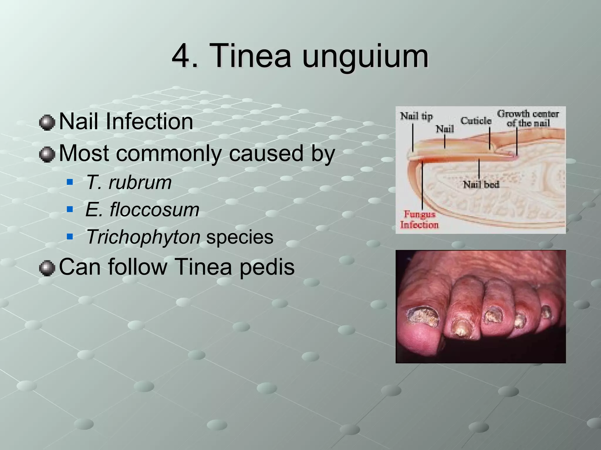 Tinea dermatophytes | PPT