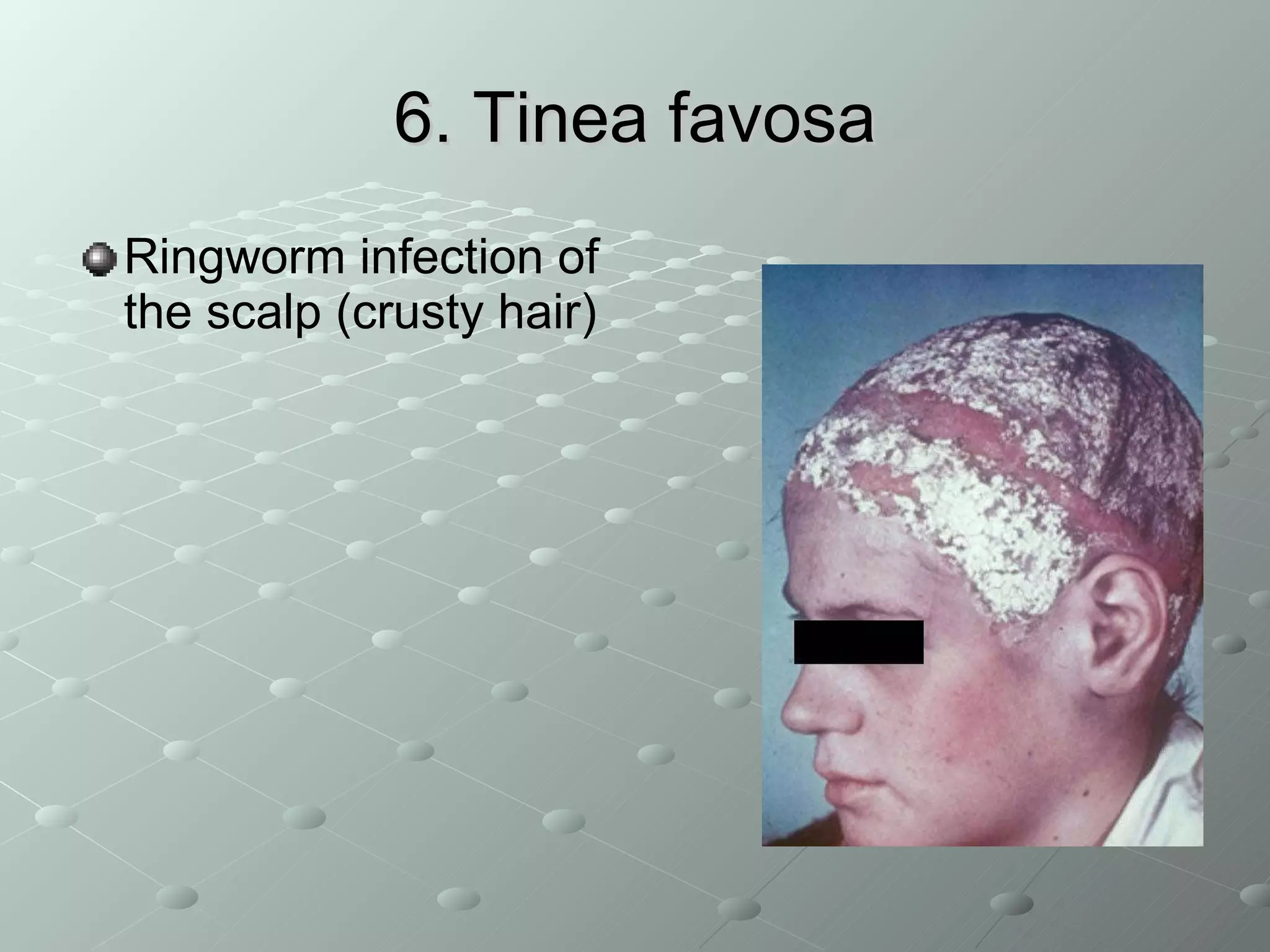 Tinea dermatophytes | PPT