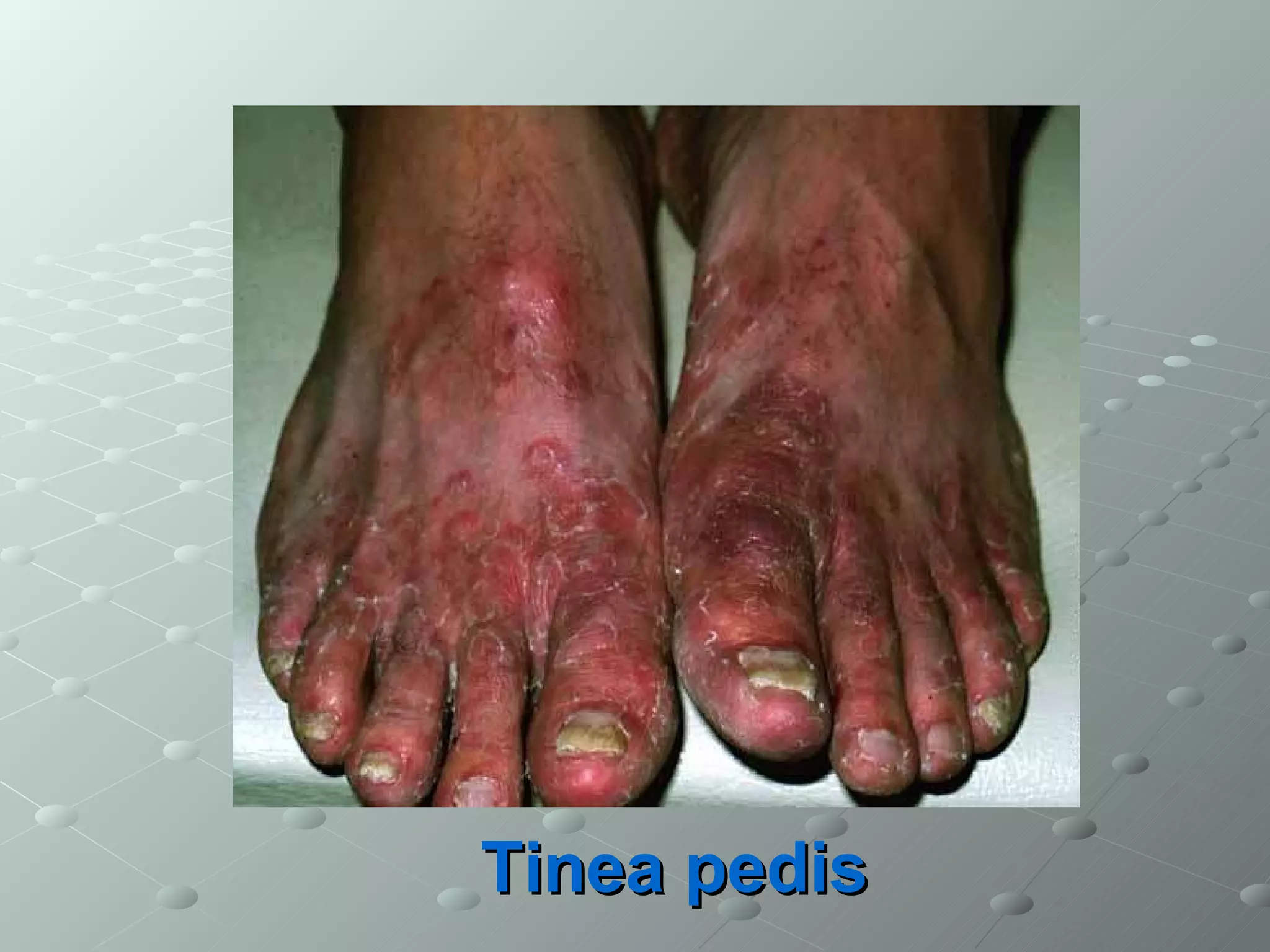 Tinea dermatophytes | PPT