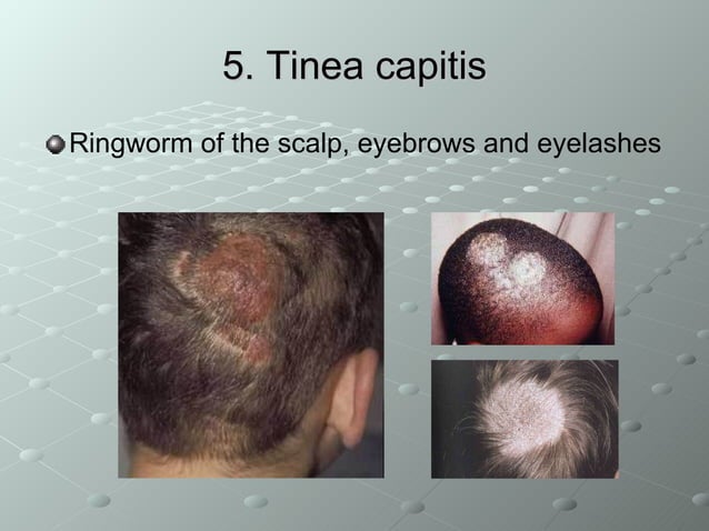 Tinea dermatophytes | PPT