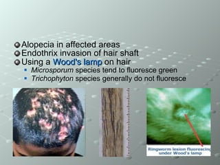 Tinea dermatophytes | PPT