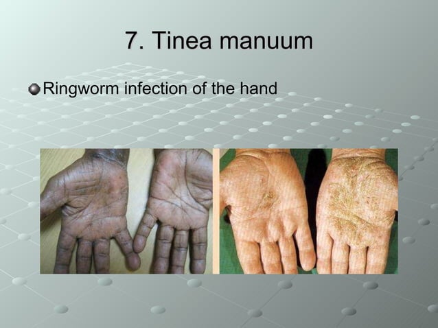 Tinea dermatophytes | PPT