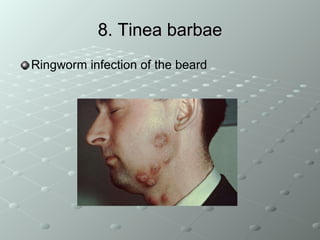Tinea dermatophytes | PPT