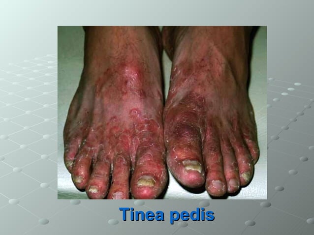 Tinea dermatophytes | PPT