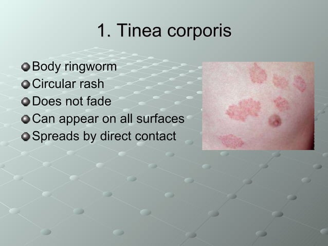Tinea dermatophytes | PPT