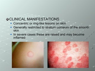 Tinea dermatophytes | PPT