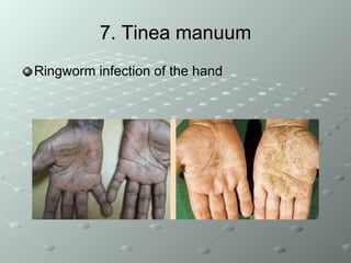 Tinea Manuum Treatment