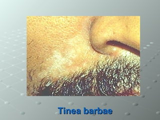 Tinea Faciei Beard