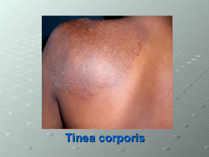 Tinea dermatophytes