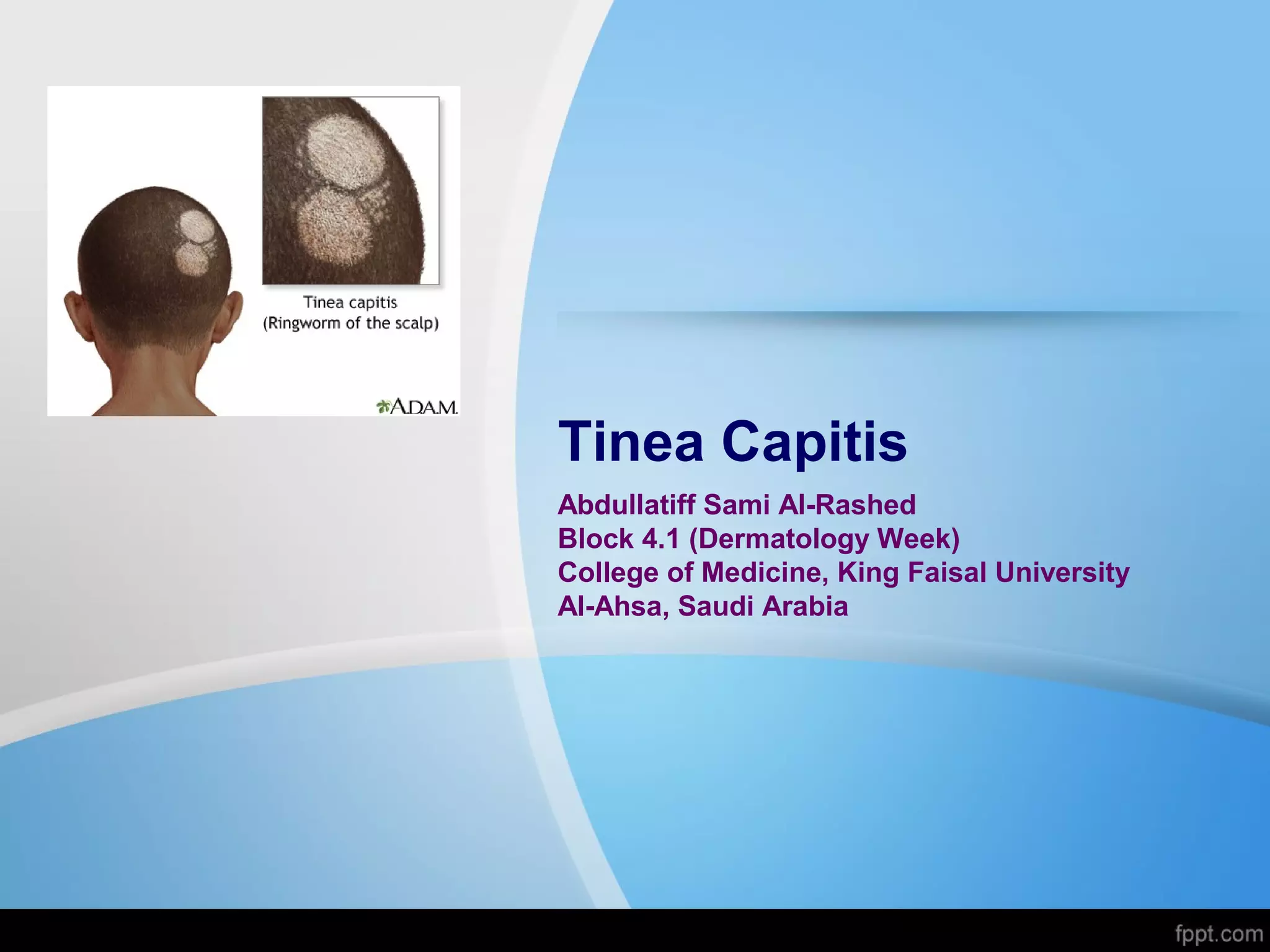 Tinea Capitis | PPT
