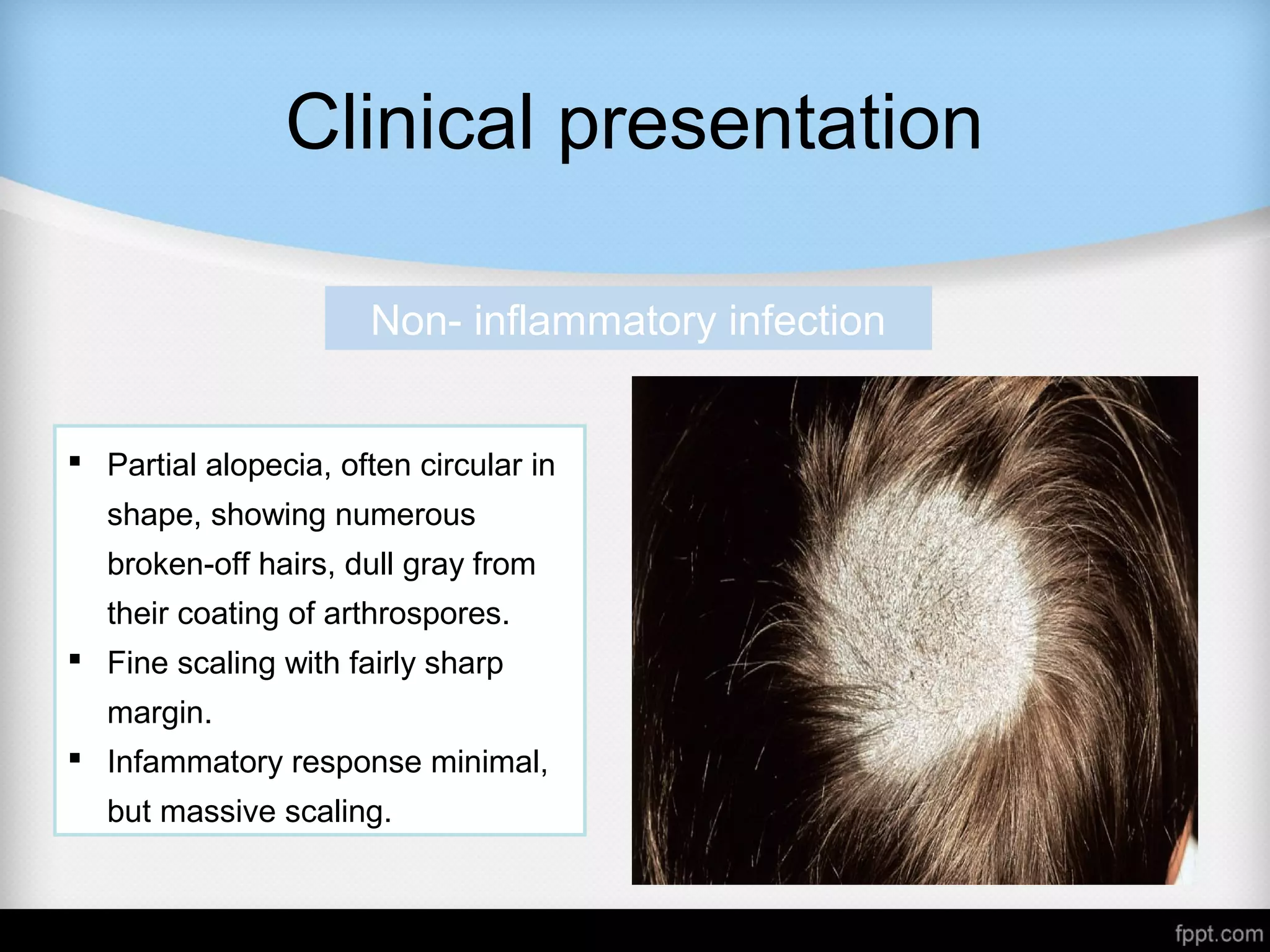 Tinea Capitis | PPT
