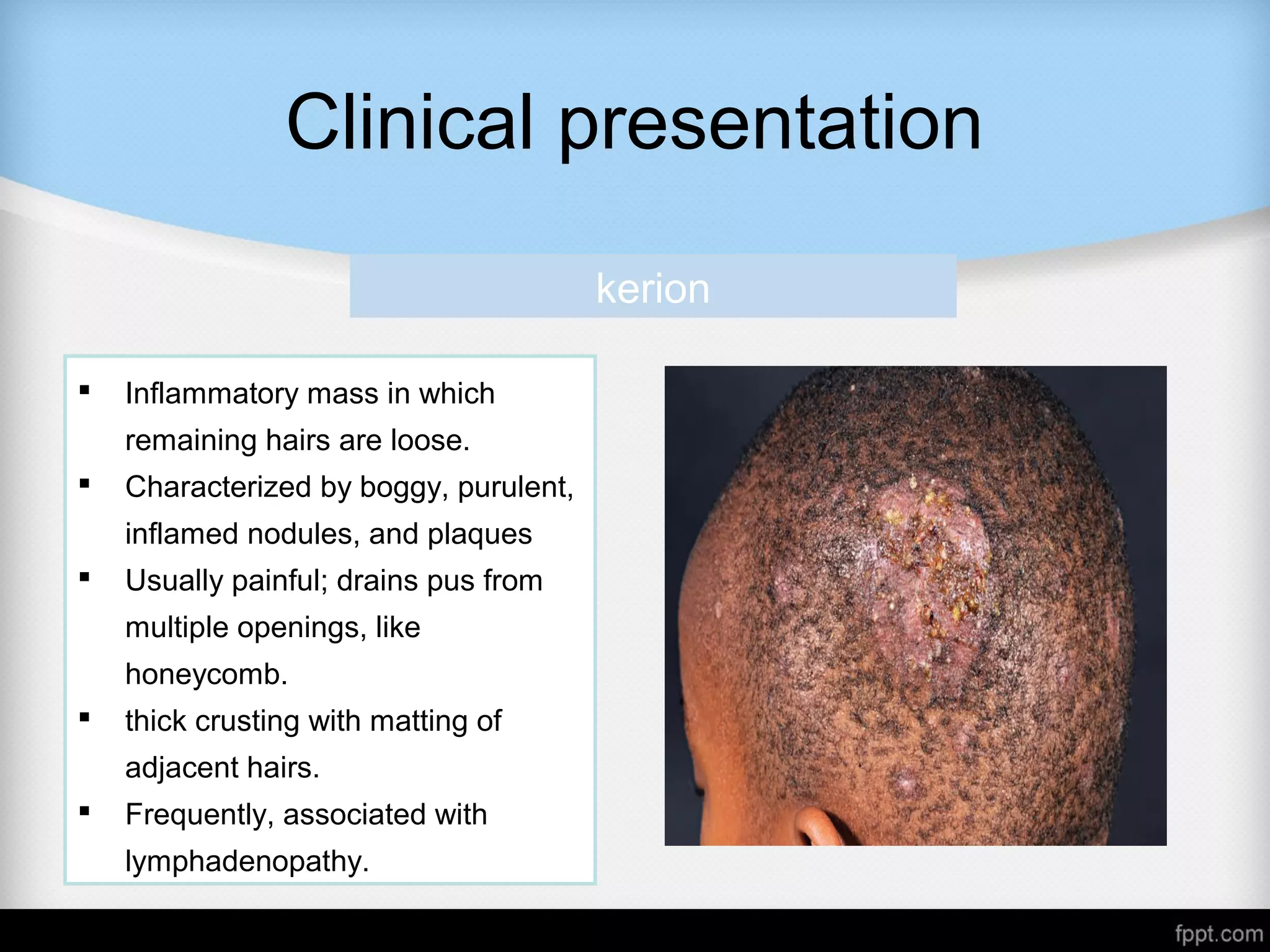 Tinea Capitis | PPT