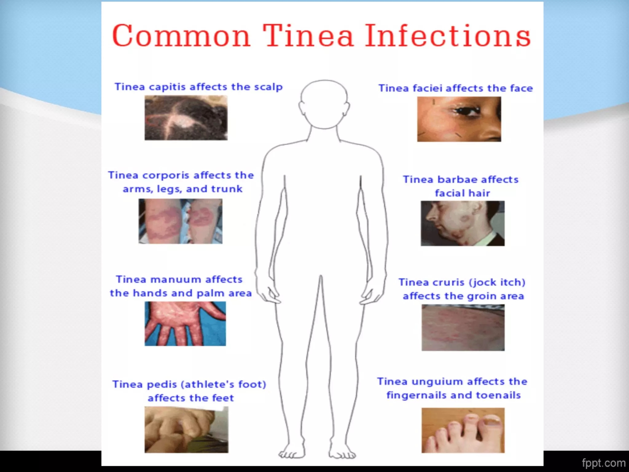 Tinea Capitis | PPT
