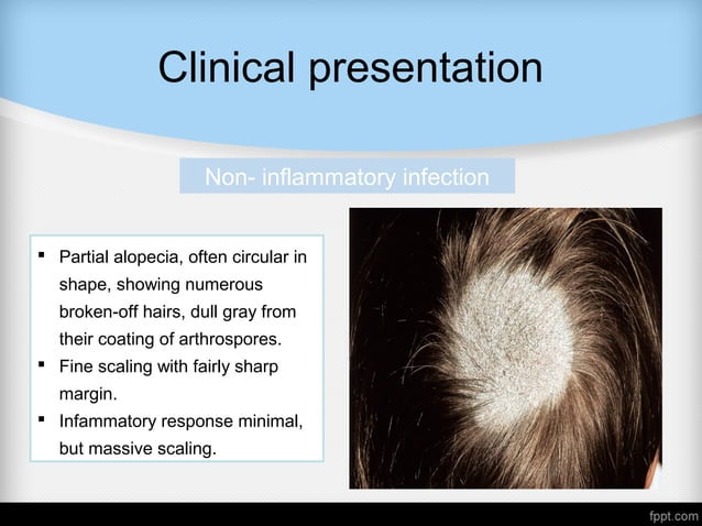 Tinea Capitis | PPT | Skin and Dermatology | Diseases and Conditions