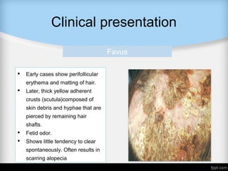 Tinea Capitis | PPT