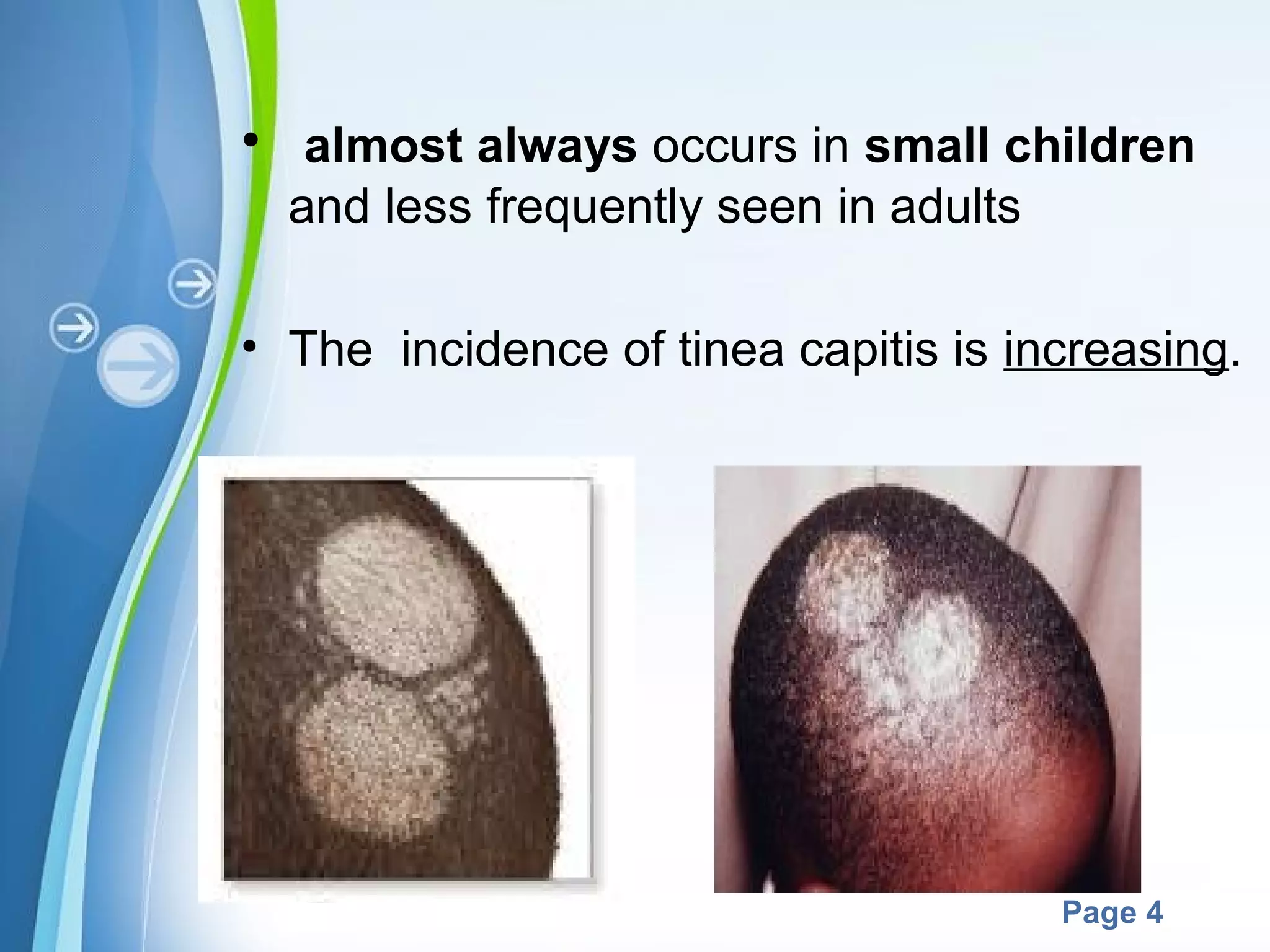 Tinea capitis | PPT