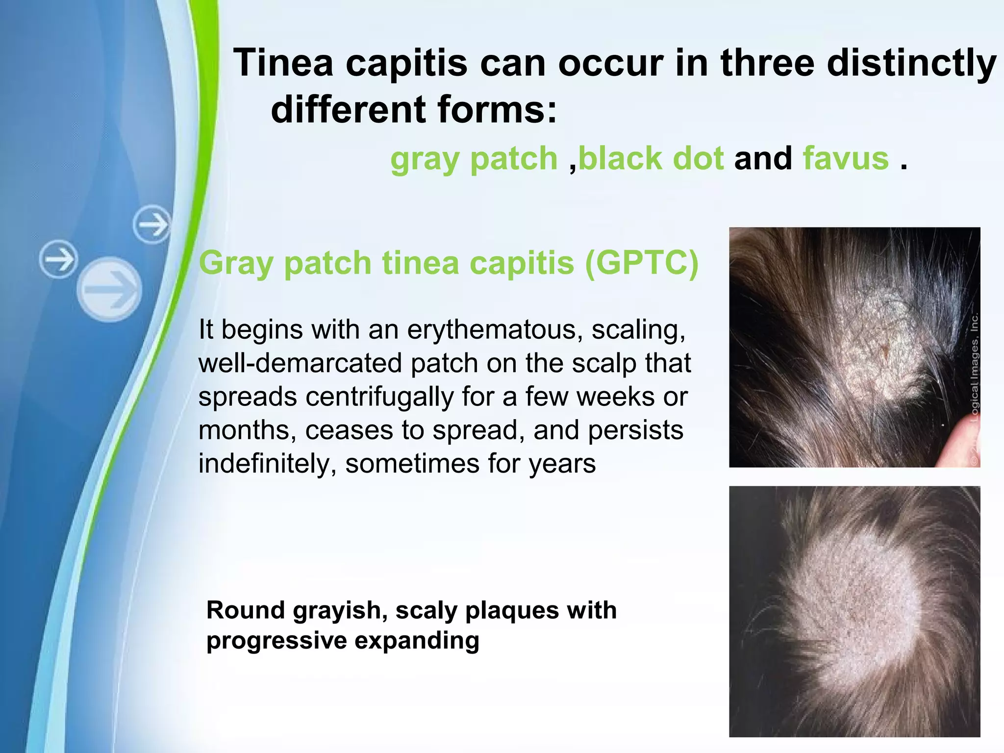 Tinea capitis | PPT