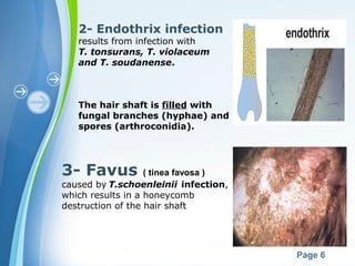 Tinea capitis | PPT