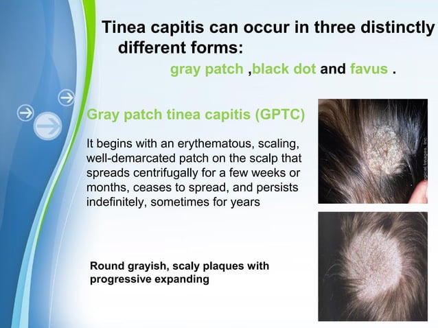 Tinea capitis | PPT | Skin and Dermatology | Diseases and Conditions