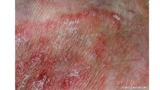 Tinea cruris | PPTX