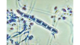 Tinea cruris | PPTX