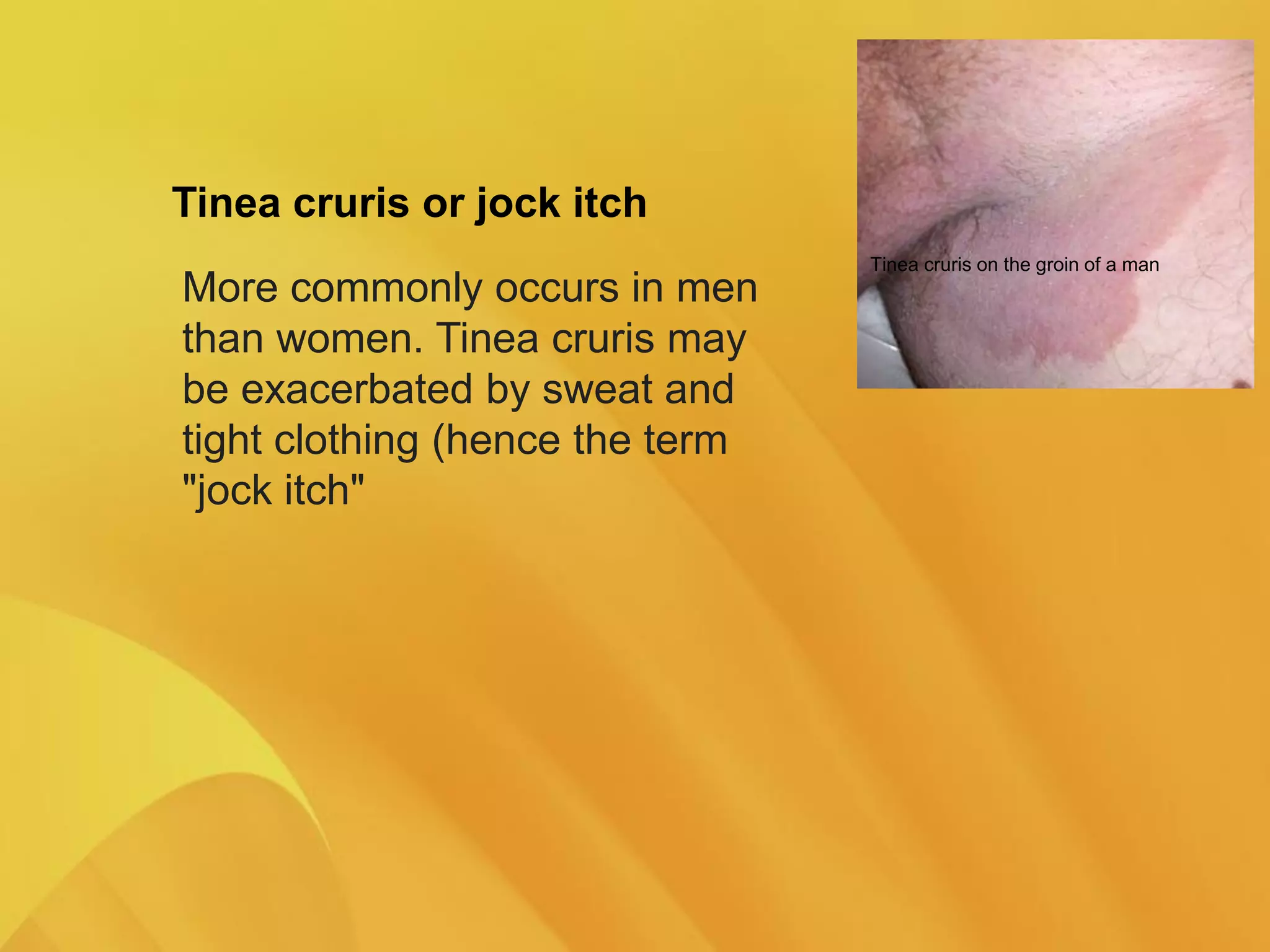 tinea cruris.pdf | Skin and Dermatology | Diseases and Conditions