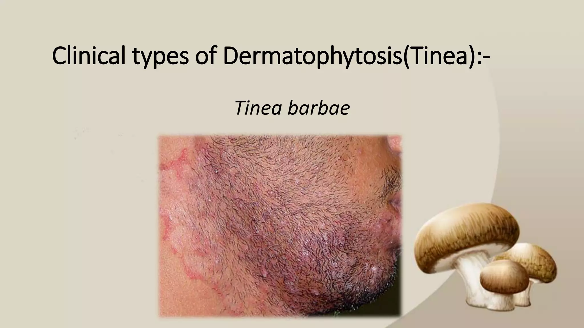 Tinea cruris(Jock itch) | PPSX