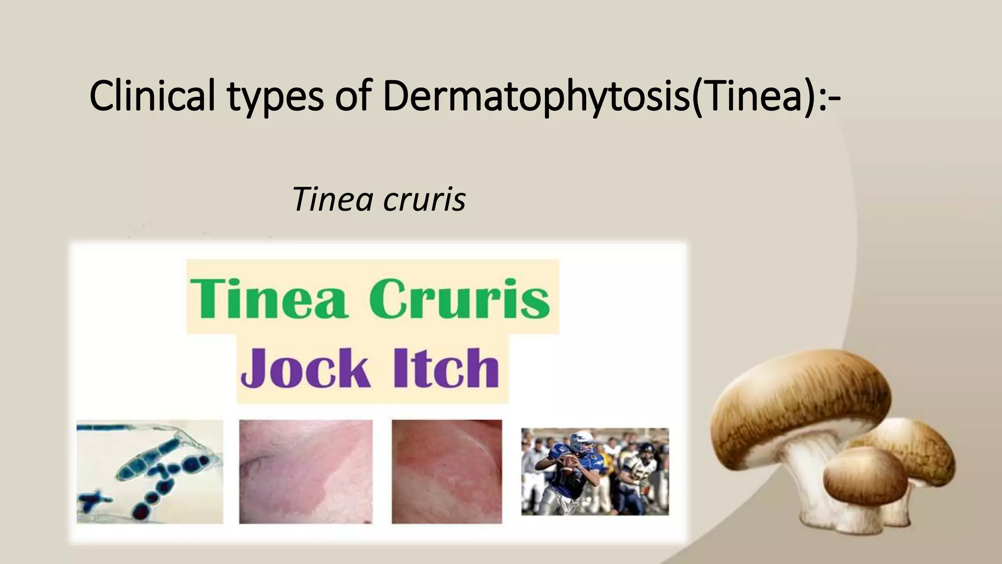 Tinea cruris(Jock itch) | PPSX