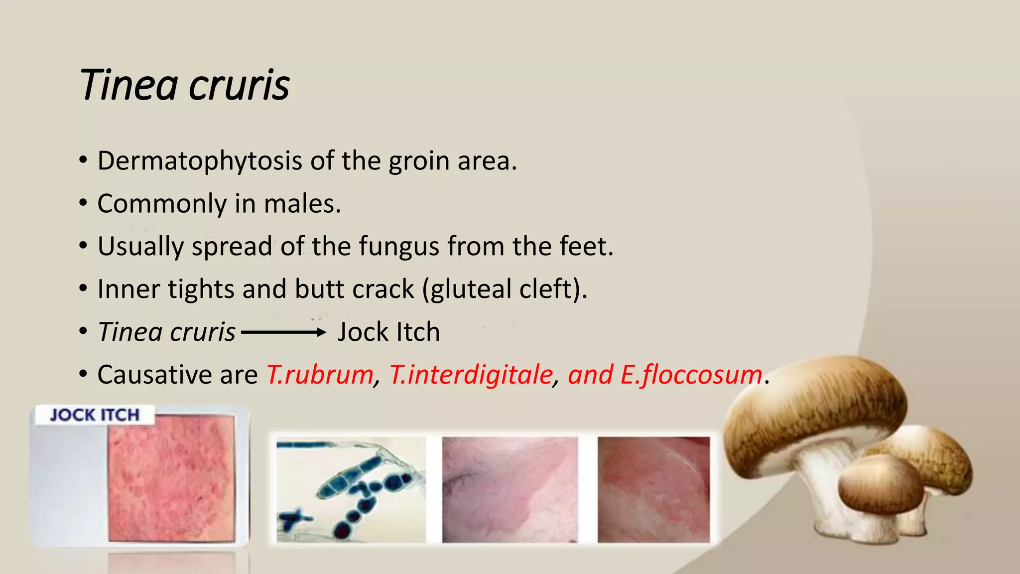 Tinea cruris(Jock itch) | PPSX