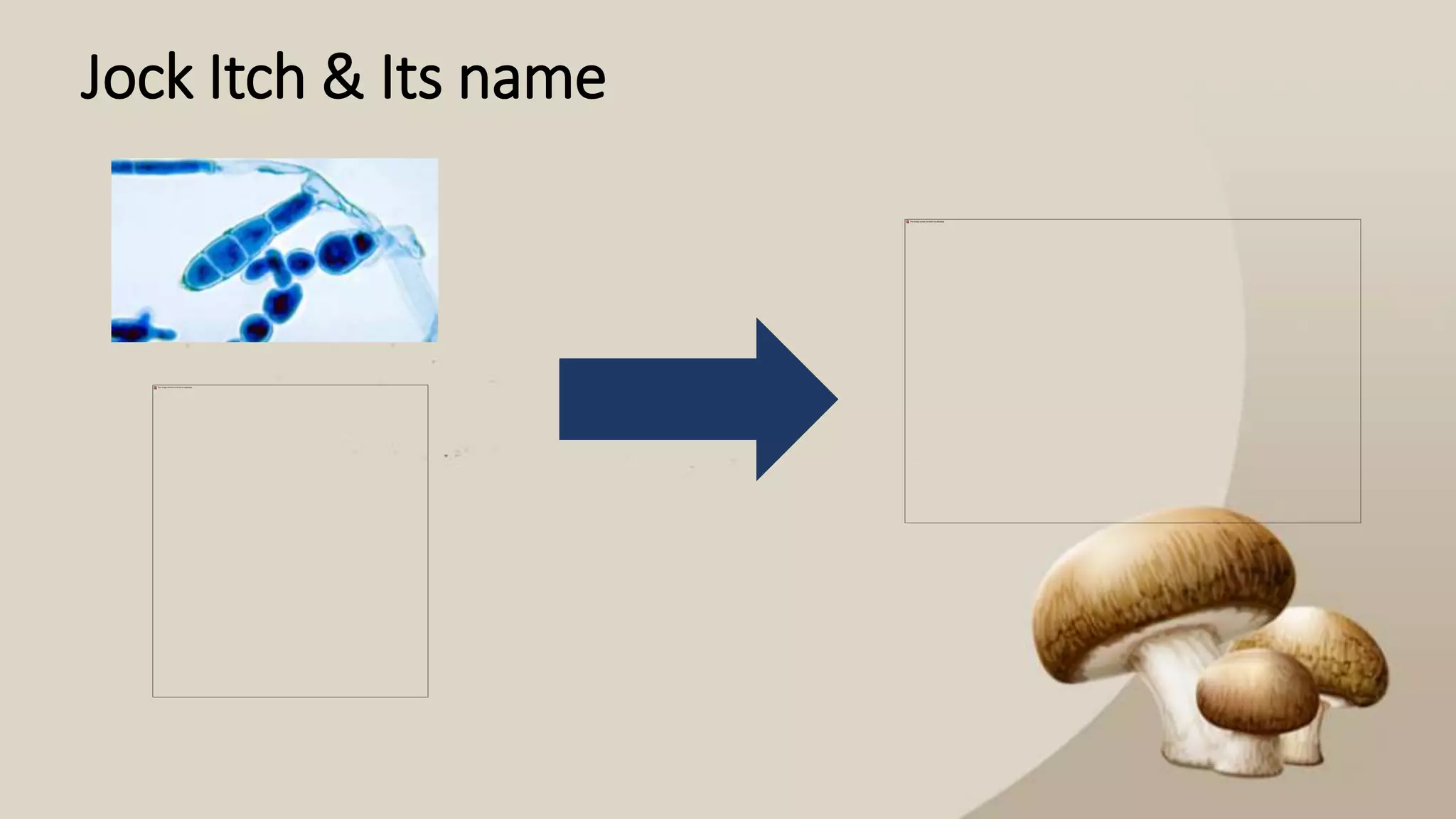 Tinea cruris(Jock itch) | PPSX