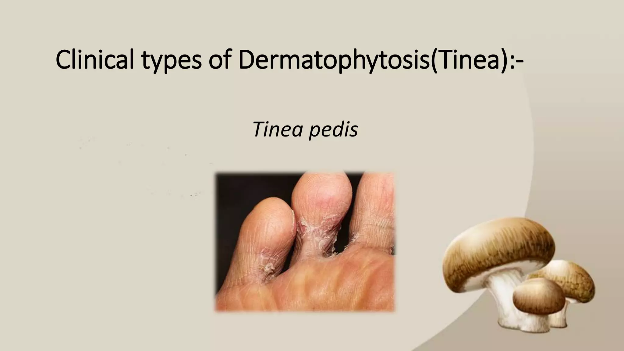 Tinea cruris(Jock itch) | PPSX