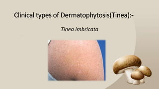 Tinea cruris(Jock itch) | PPSX