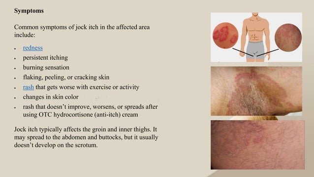 Tinea cruris(Jock itch) | PPSX