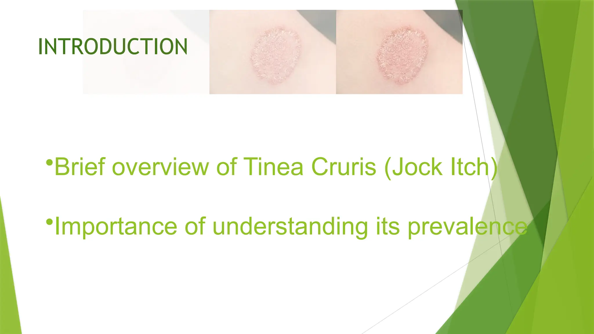 Jock Itch (Tinea Cruris) Jock itch is a contagious fungal infection ...